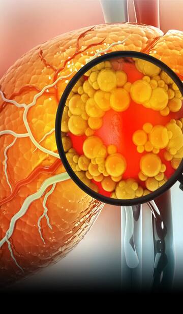 கொழுப்புக் கல்லீரல் ஏற்பட காரணங்களும் தீர்வுகளும்! | Tamil Web Stories ...